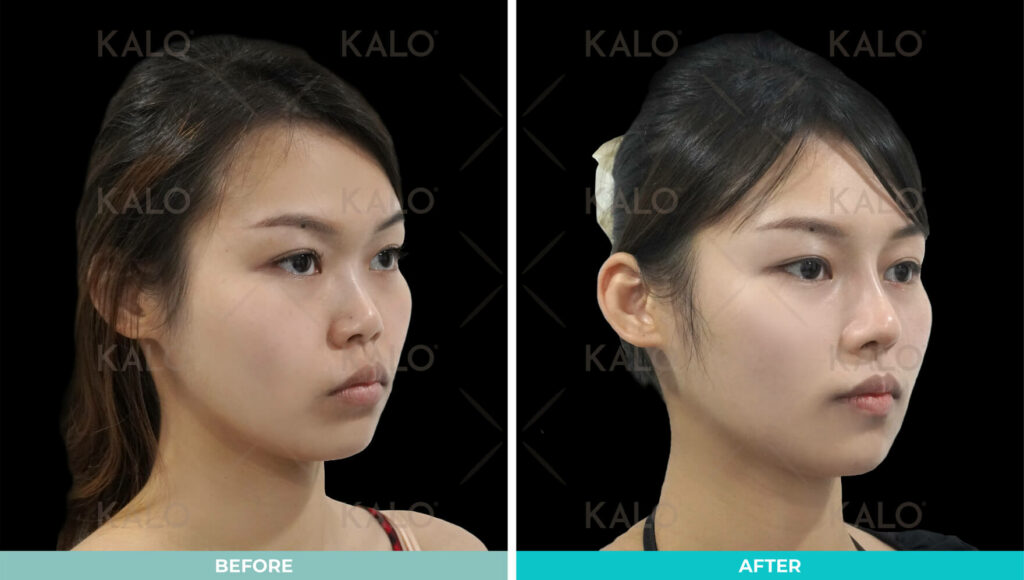 Rhinoplasty Malaysia - Nose Cartilage Implant - KALO